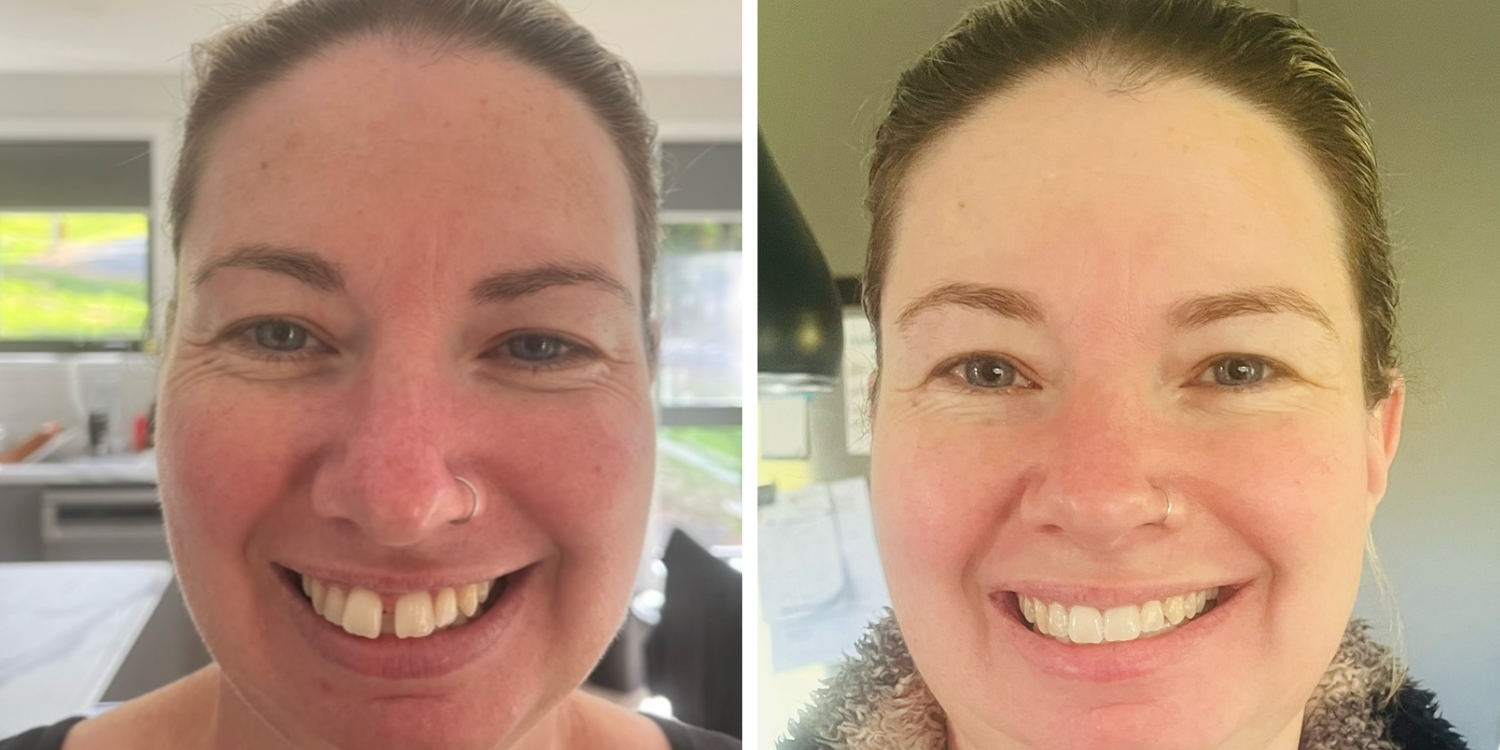 The Emotional Impact of a Straighter Smile With Bitesoft Co. – bitesoft ...