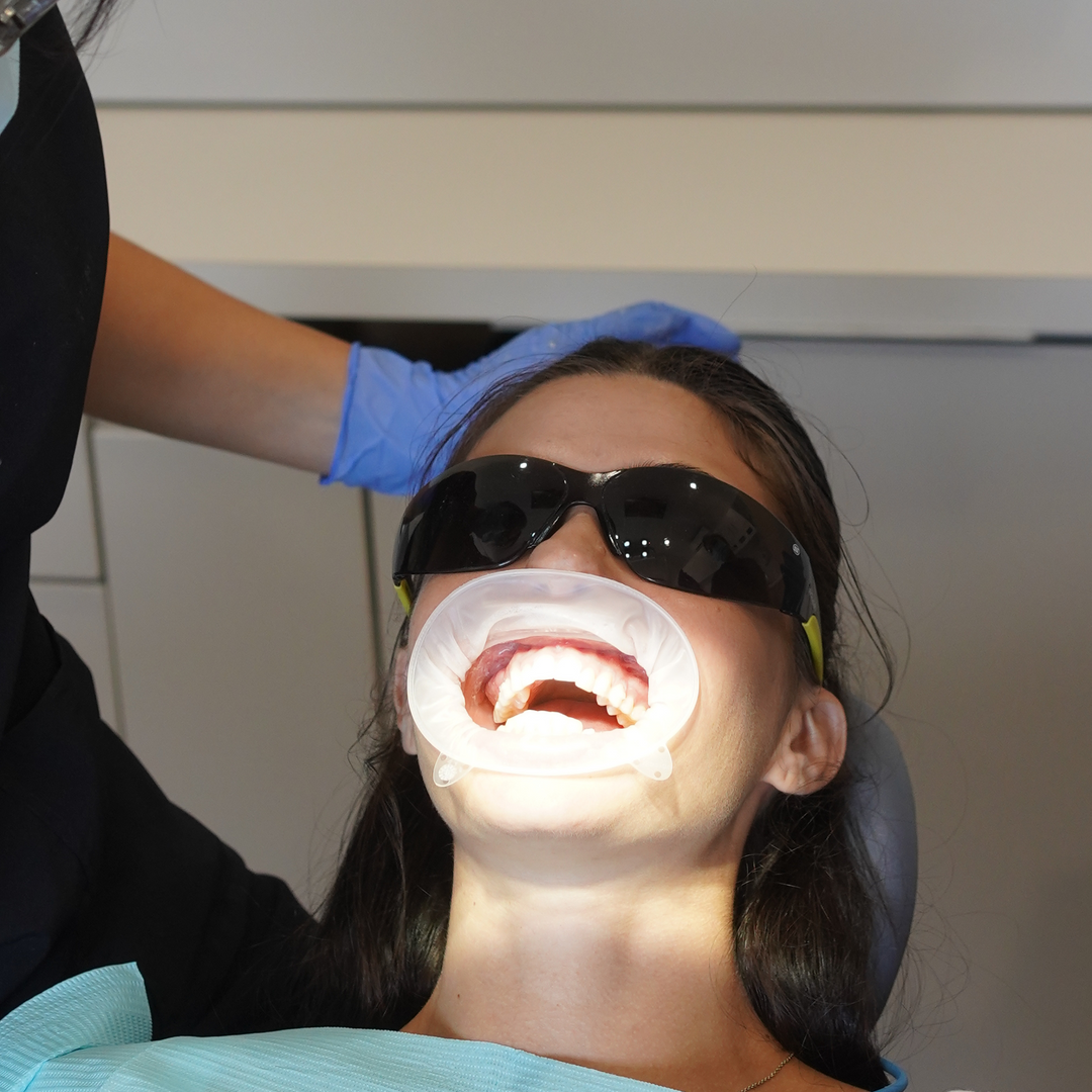 What is a Snaggletooth and How to Fix It | Bitesoft Co – bitesoft dental