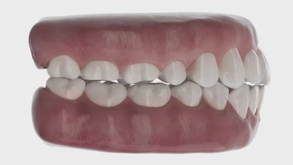 Overbite: Causes, Symptoms & Treatment – bitesoft dental